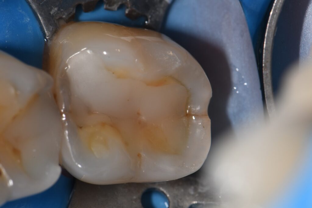How to Restore a Tooth with Cracks on Both Sides