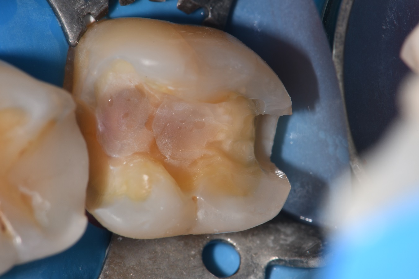 How to Restore a Tooth with Cracks on Both Sides