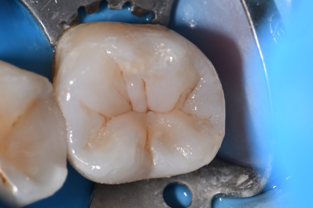 How to Restore a Tooth with Cracks on Both Sides