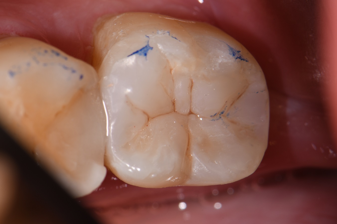 How to Restore a Tooth with Cracks on Both Sides