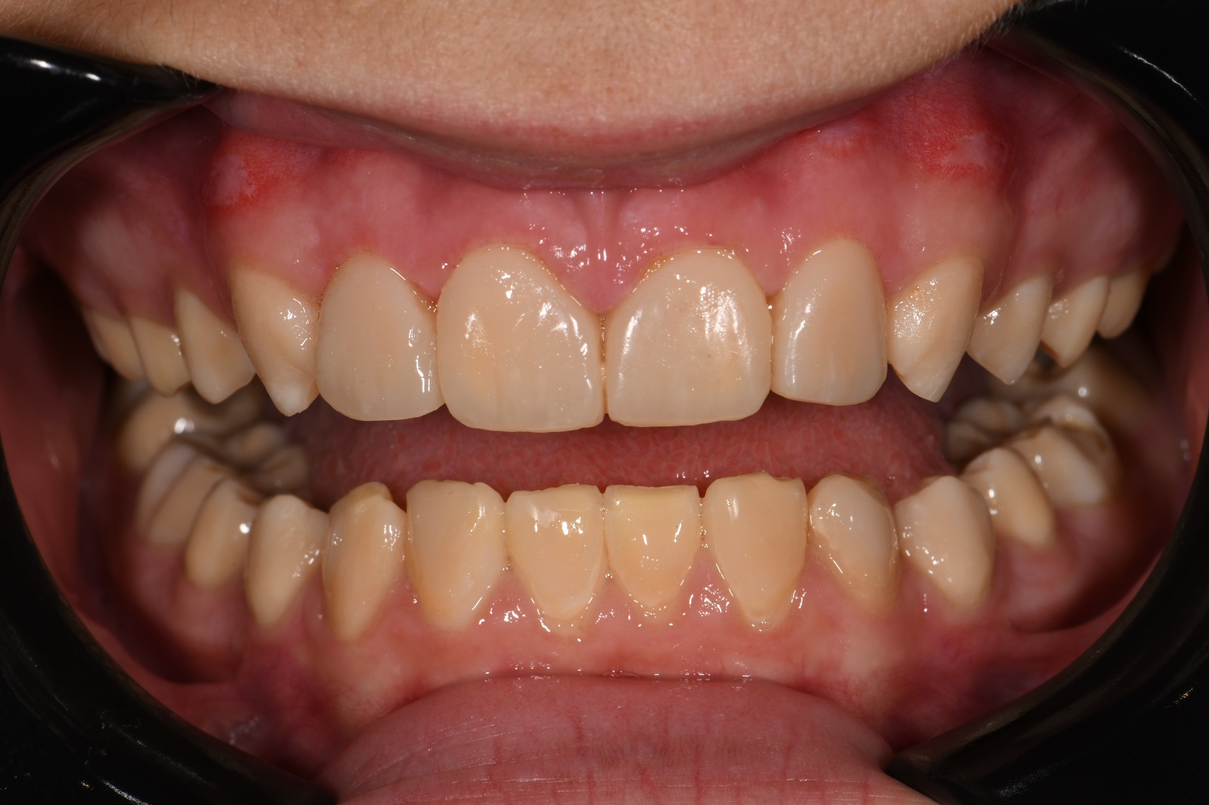 Restoring smiles affected by Amelogenesis Imperfecta