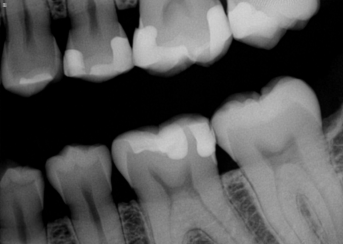 Slot Restoration | Grade D3 caries Slot Restoration | Grade D3 caries