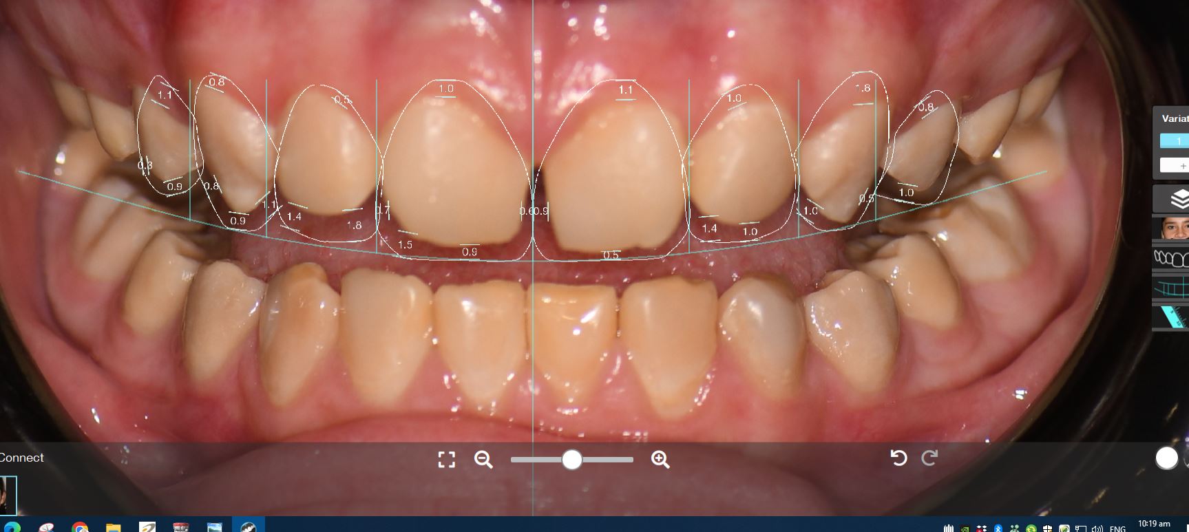Digital Smile Design Guided Composite Veneers
