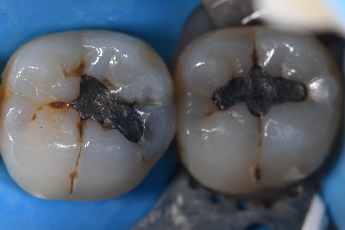 Garrison Strata-G Sectional Matrix