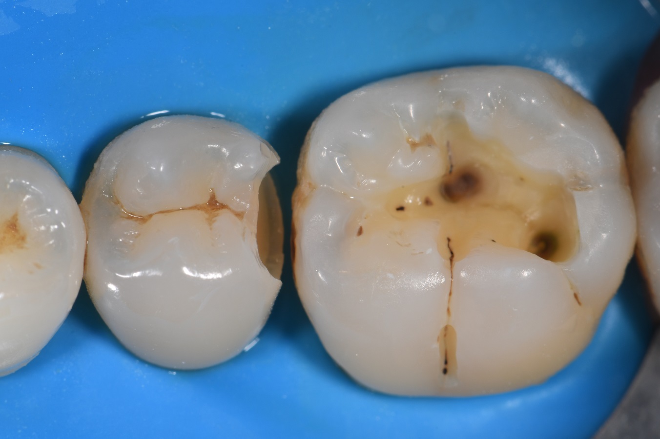 Garrison Strata-G Sectional Matrix