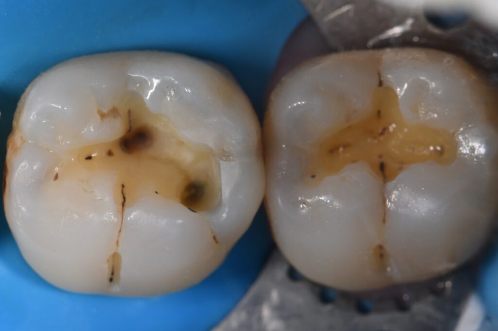 Garrison Strata-G Sectional Matrix