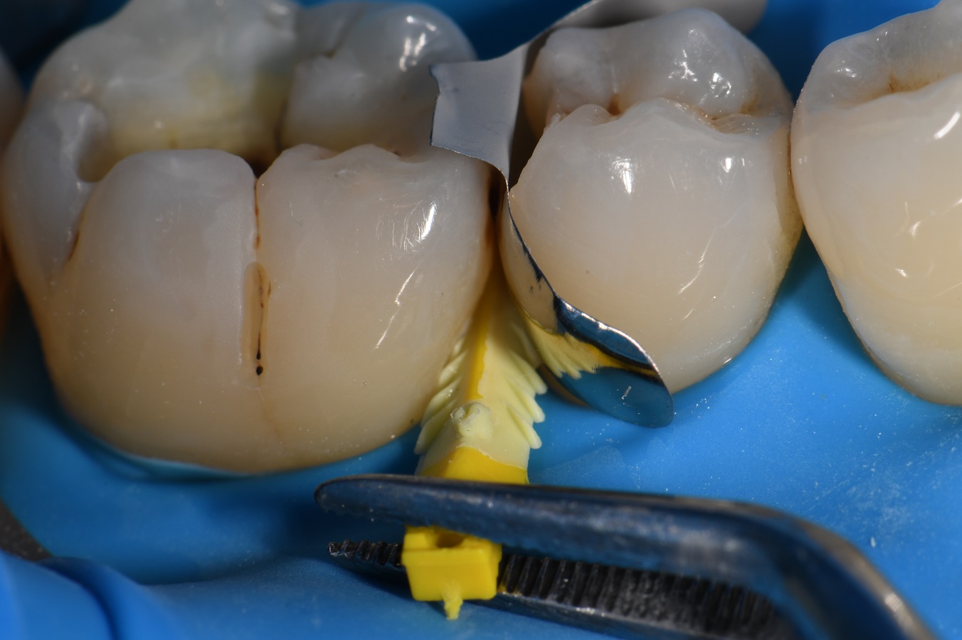 Garrison Strata-G Sectional Matrix