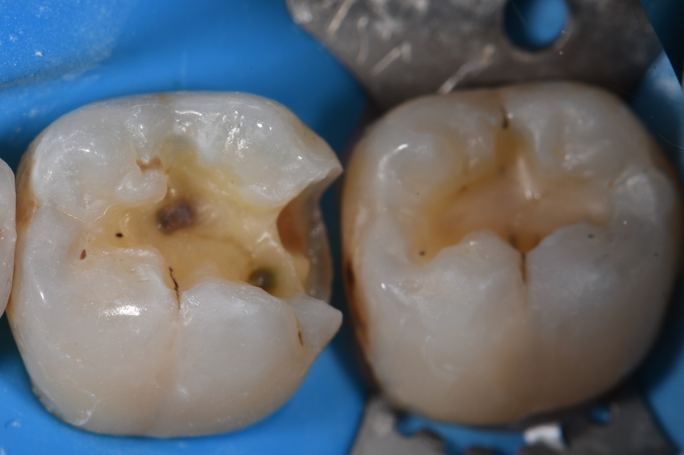 Garrison Strata-G Sectional Matrix