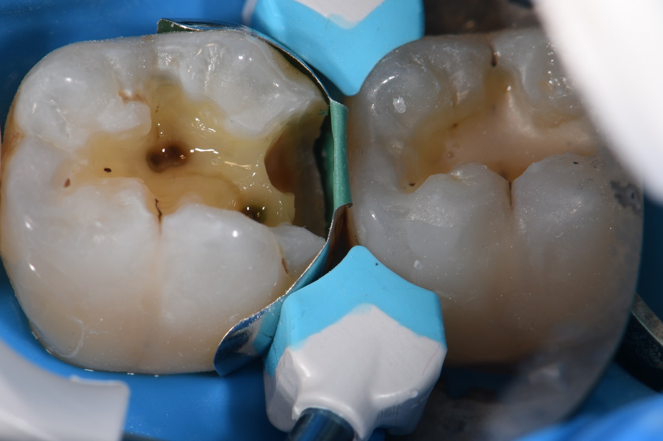Garrison Strata-G Sectional Matrix