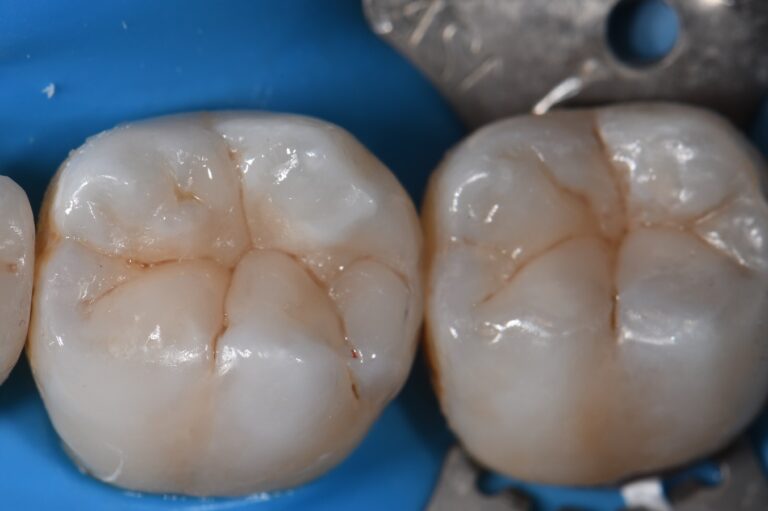 Garrison Strata-G Sectional Matrix