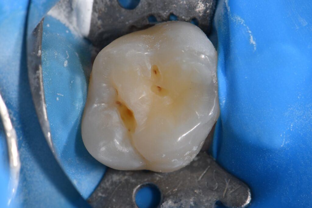Fissure Sealant Treatment Plan becomes Caries