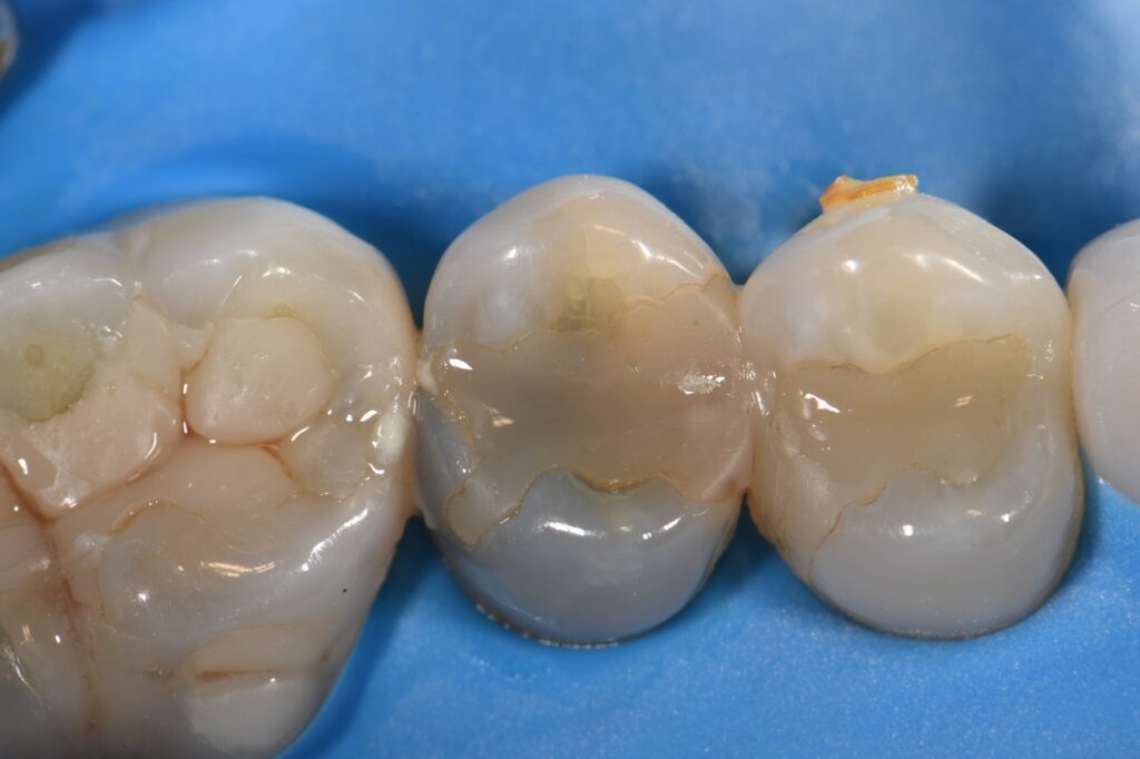 Garrison Strata-G Sectional Matrix System