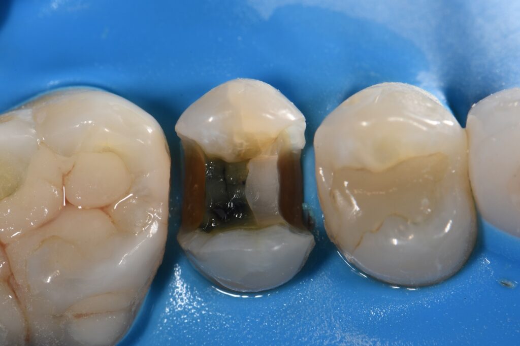 Garrison Strata-G Sectional Matrix System