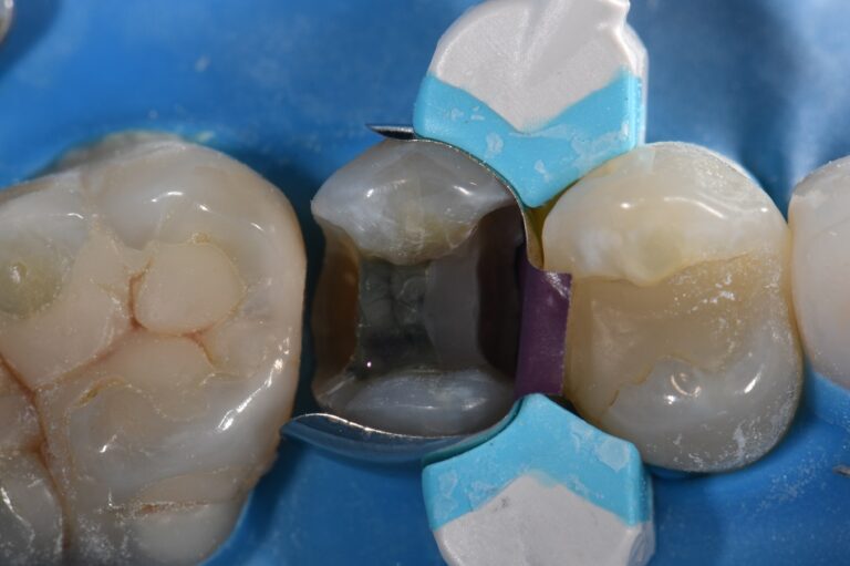 Garrison Strata-G Sectional Matrix System