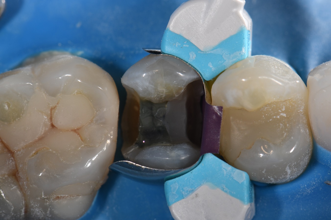 Garrison Strata-G Sectional Matrix System