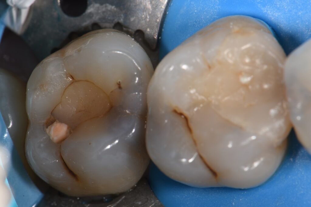 Efficient Placement of Class II Restorations