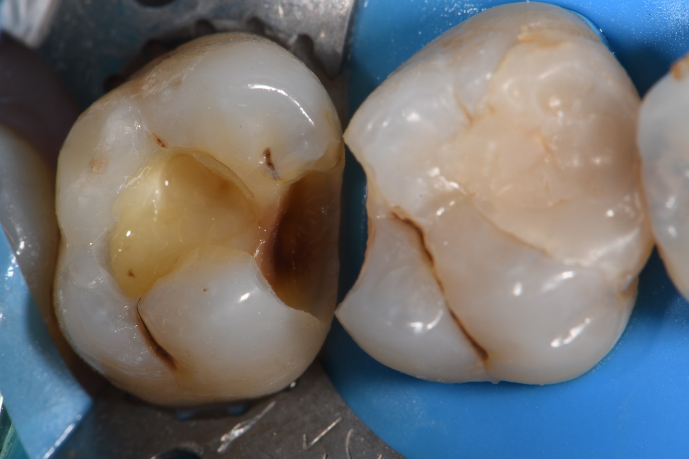 Efficient Placement of Class II Restorations