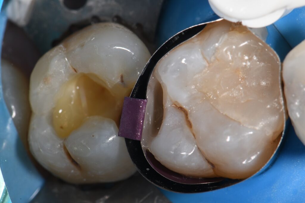 Efficient Placement of Class II Restorations