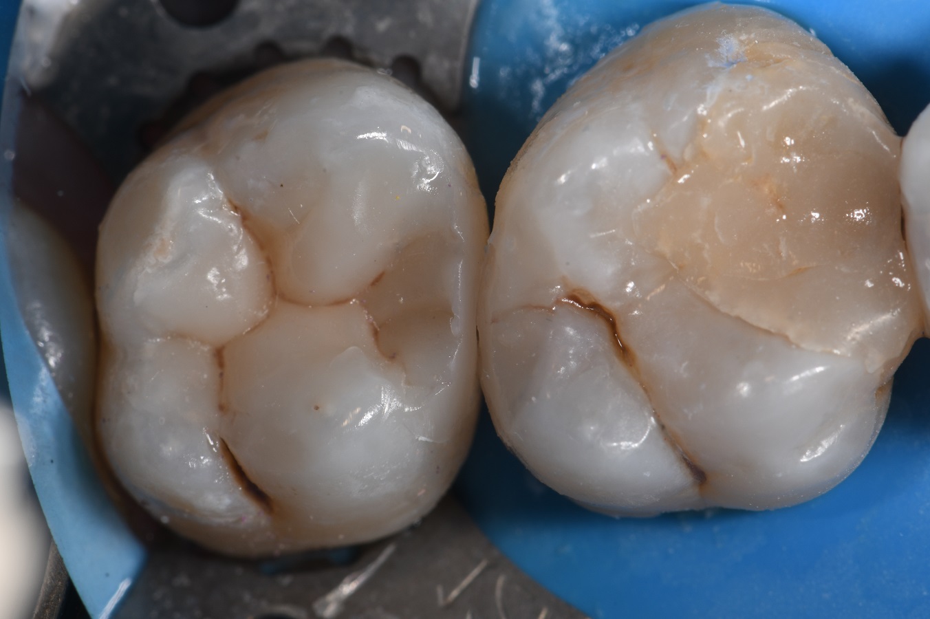 Efficient Placement of Class II Restorations