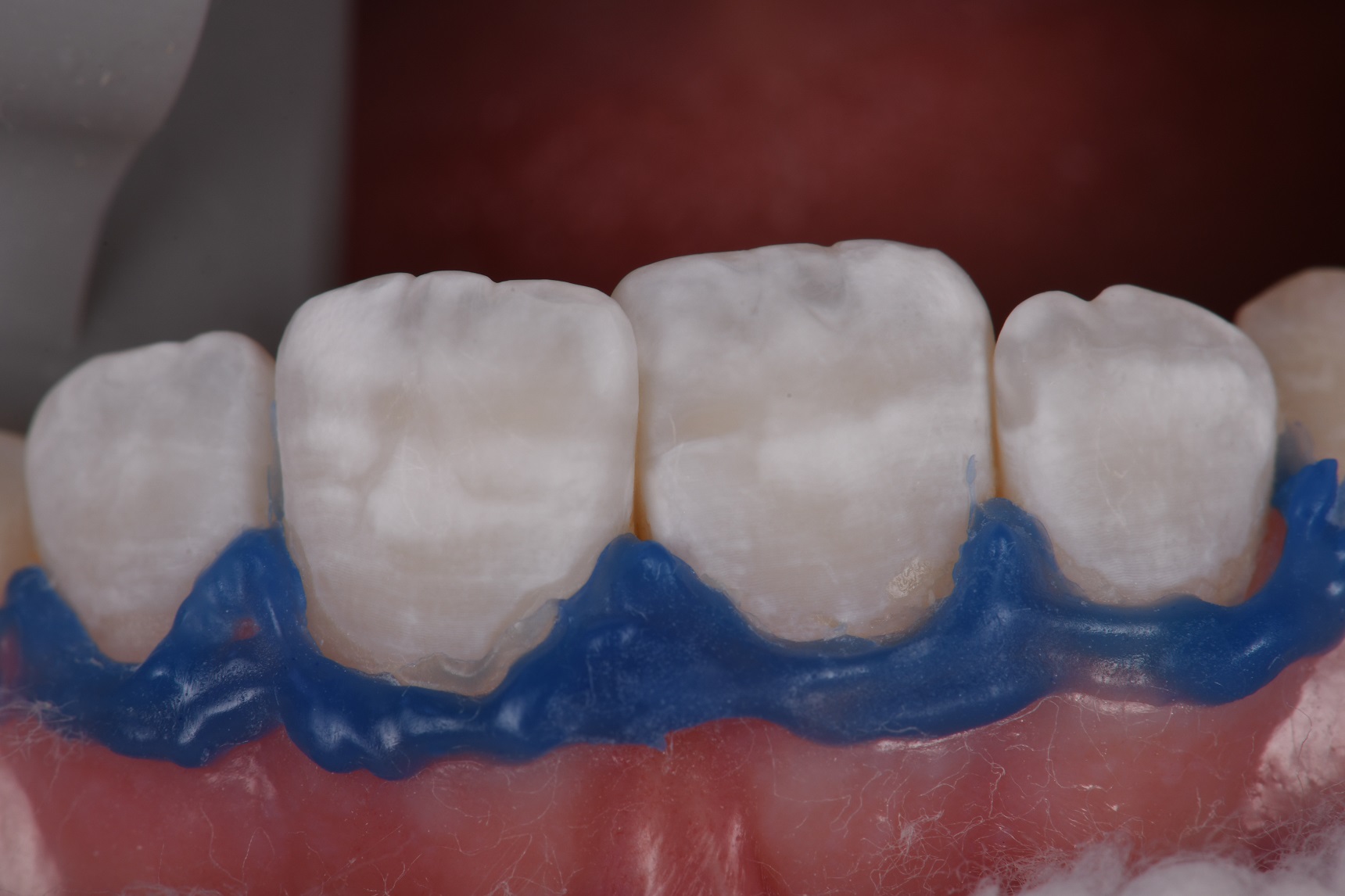 Resin Infiltration Removes White Spots on Teeth