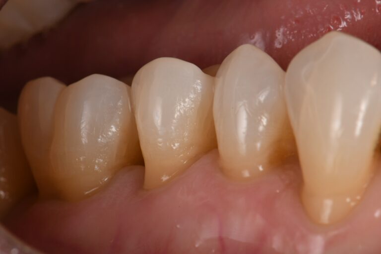 Cervical Augmentation Non Invasive Composite Restorations