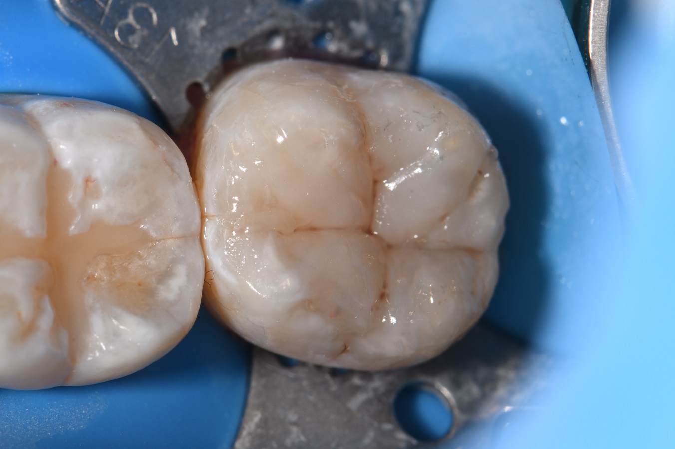 Replacing an old leaking composite filling