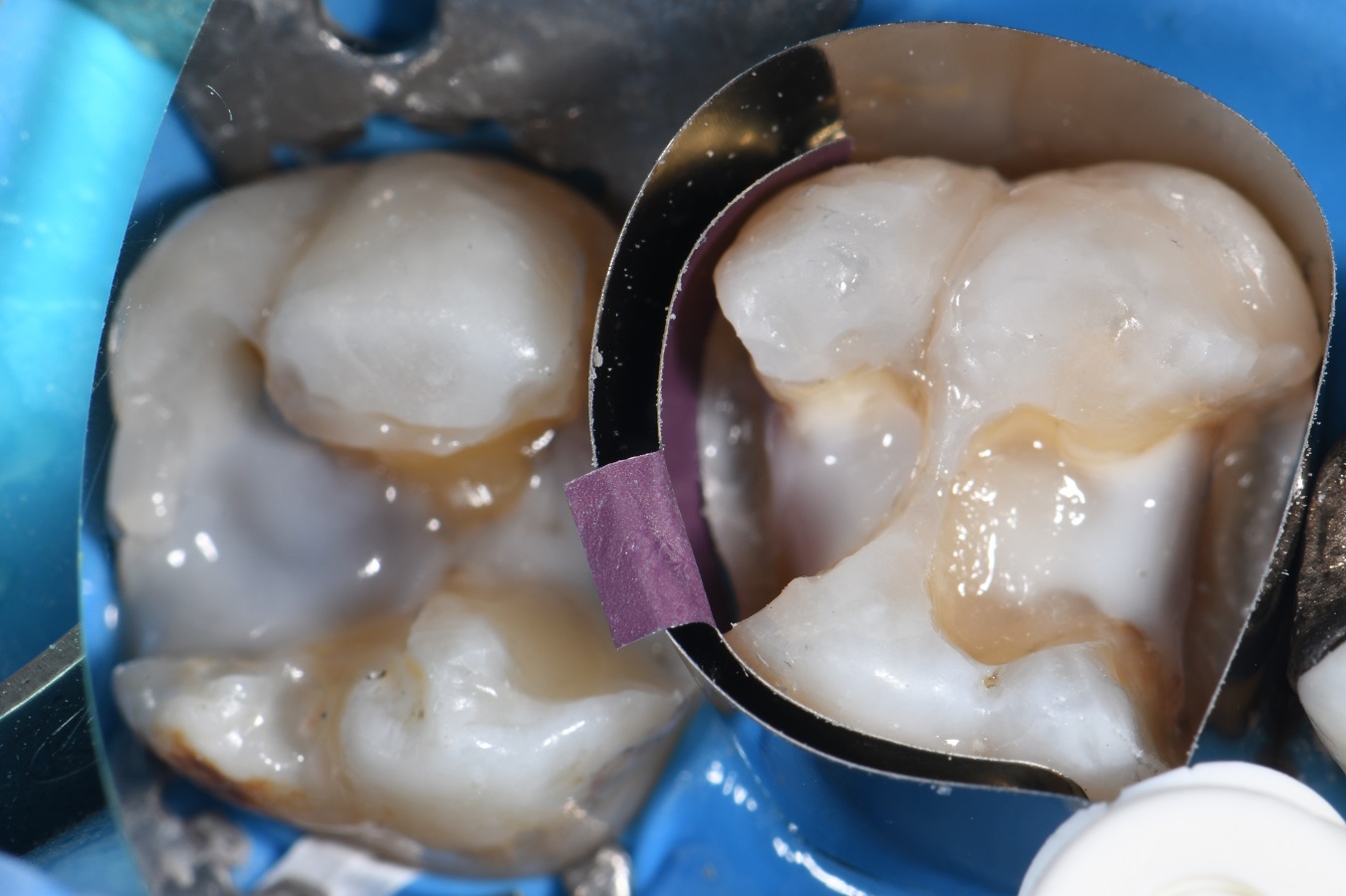 Complex Reconstruction in Composite Resin