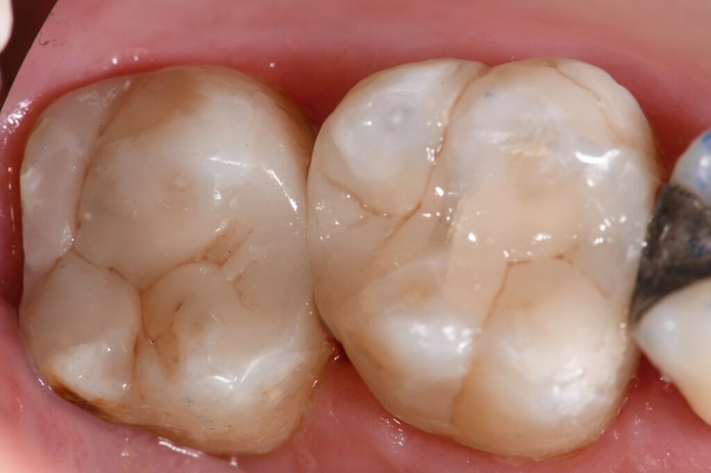 Complex Reconstruction in Composite Resin