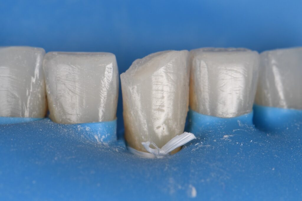 When to Use Partial Composite Layered Veneer