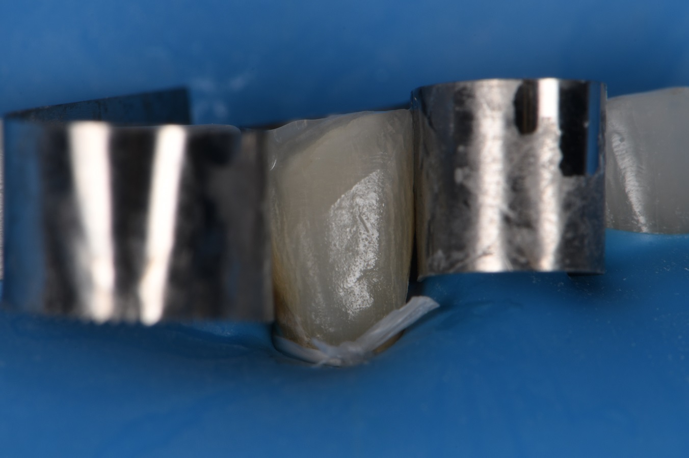 When to Use Partial Composite Layered Veneer