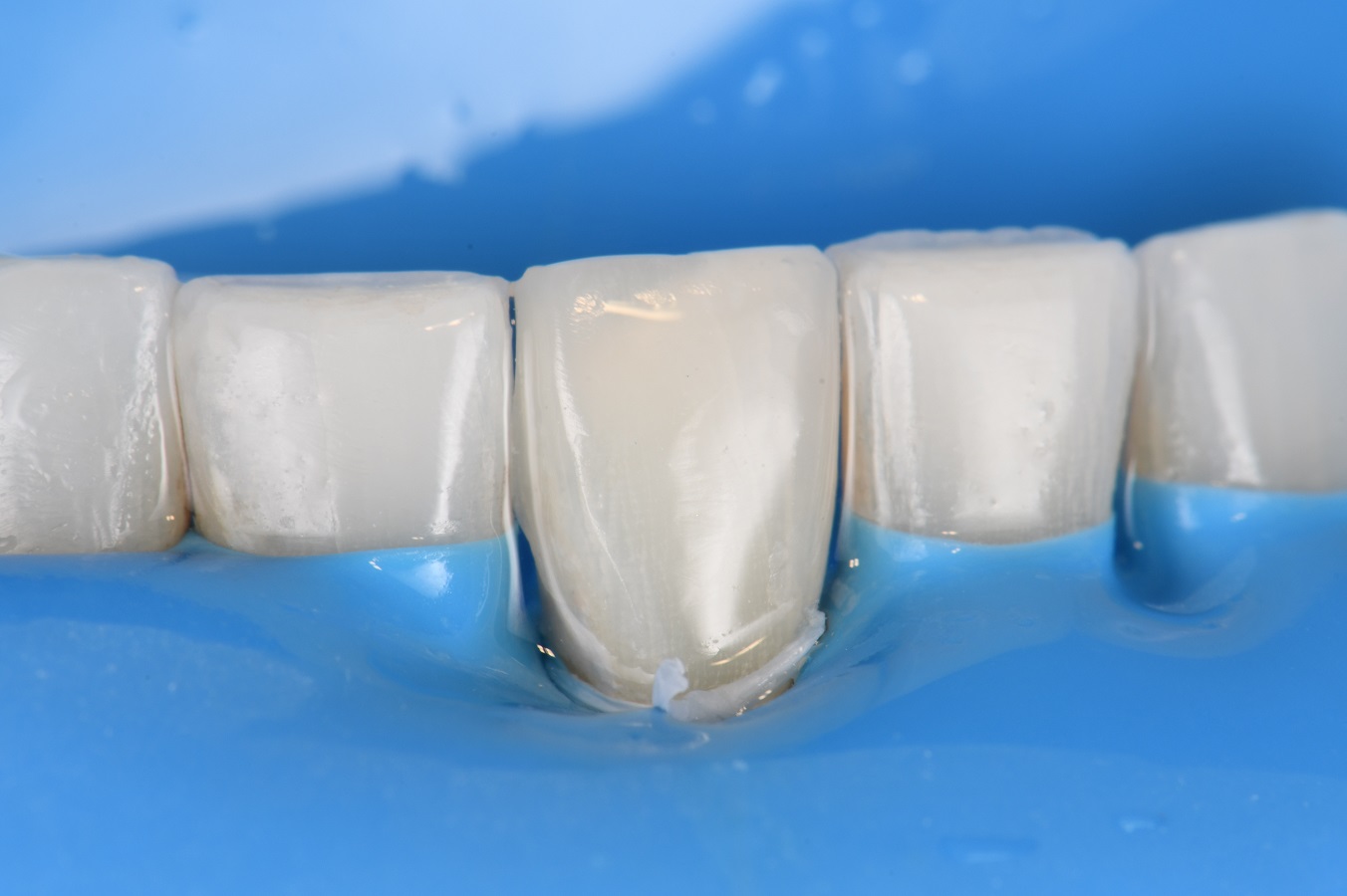 When to Use Partial Composite Layered Veneer