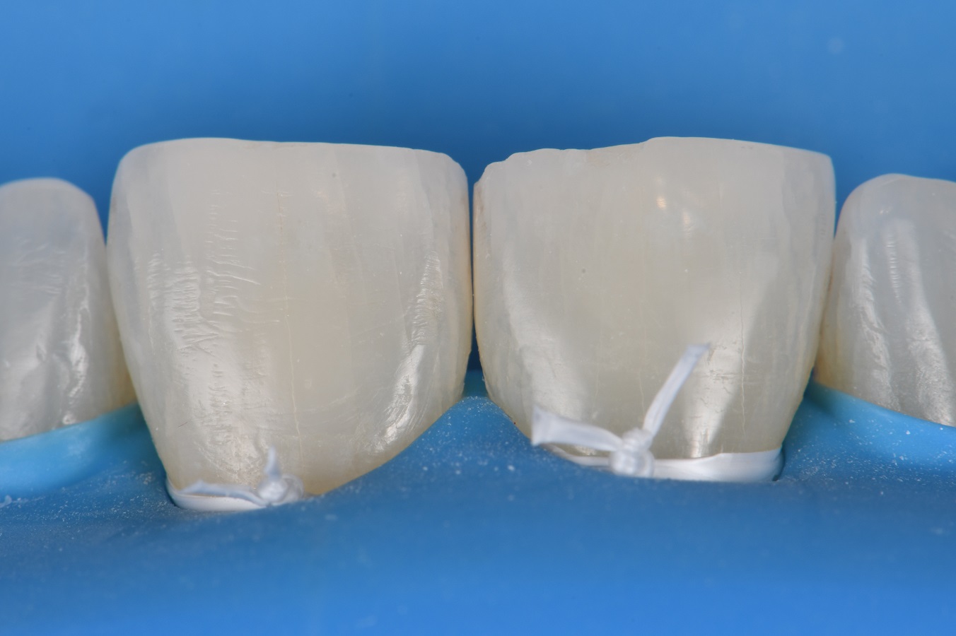 Layered Edge Bonding with Composite Resin