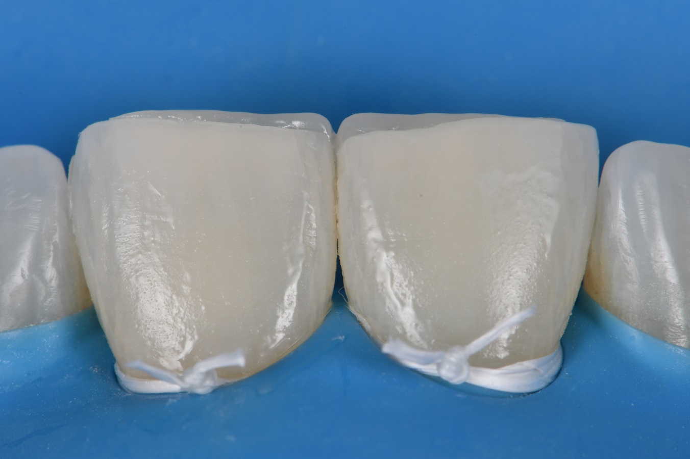 Layered Edge Bonding with Composite Resin