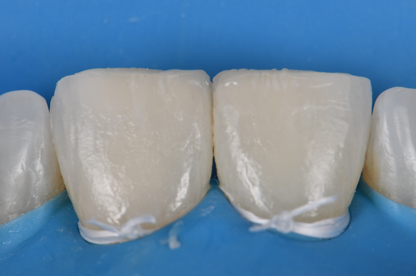 Layered Edge Bonding with Composite Resin