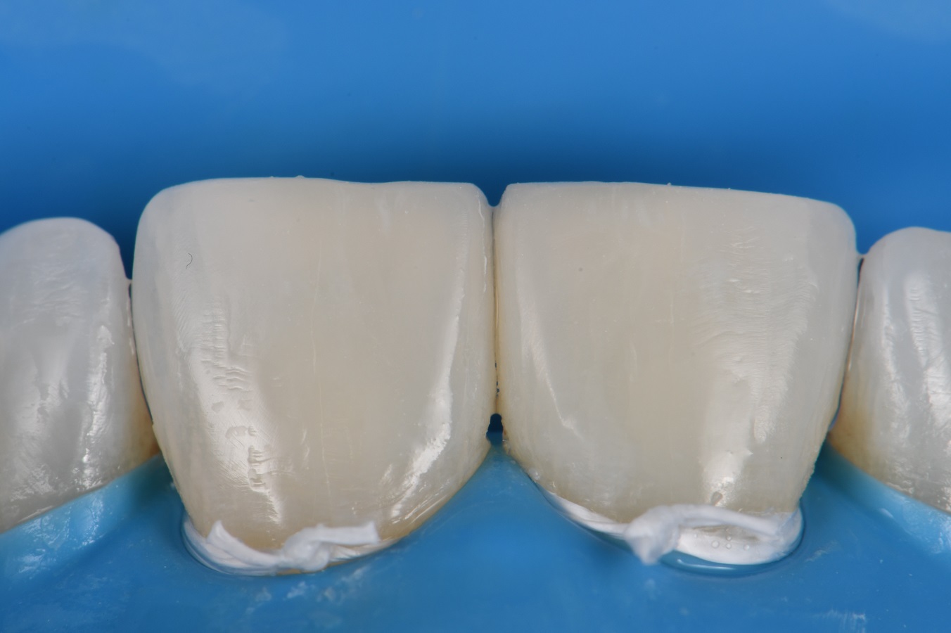 Layered Edge Bonding with Composite Resin
