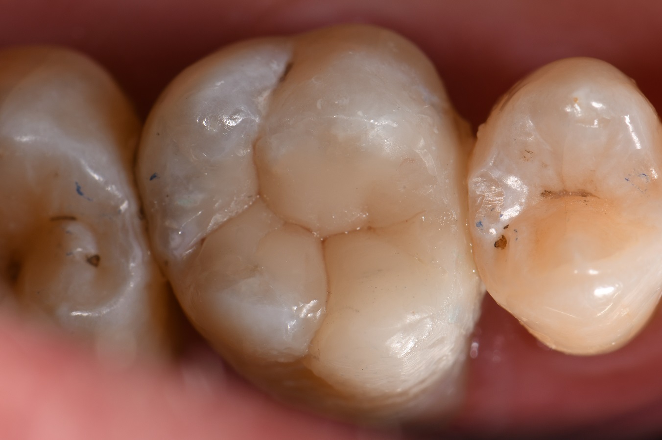 Deep Cracks from Amalgam Fillings