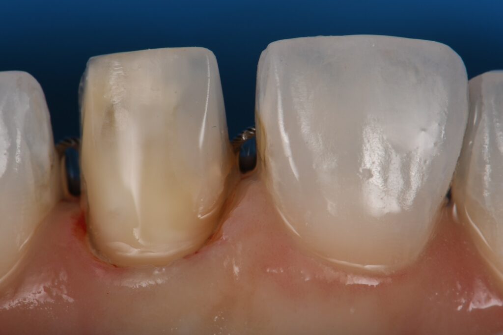 Single porcelain veneer to match natural teeth