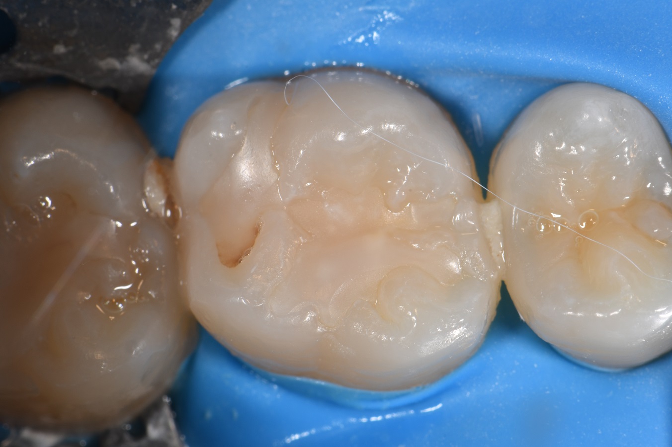 Invisible Class I composite restoration