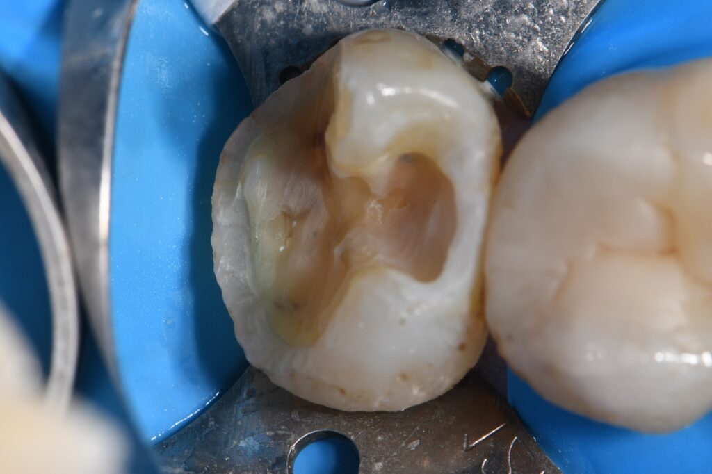 Matrix in Matrix Composite Reconstruction of Second Molar