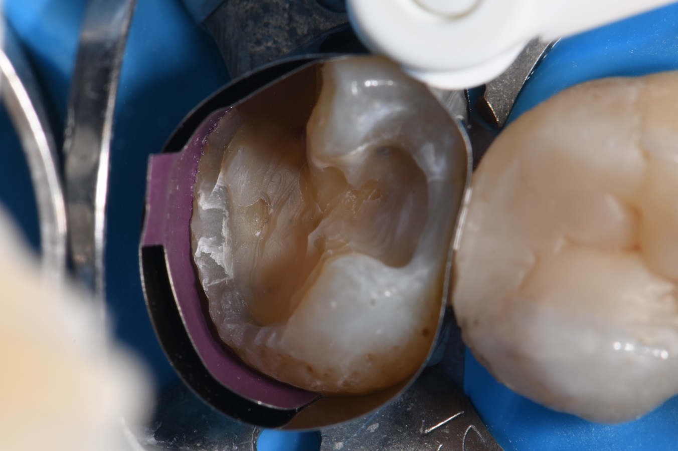 Matrix in Matrix Composite Reconstruction of Second Molar