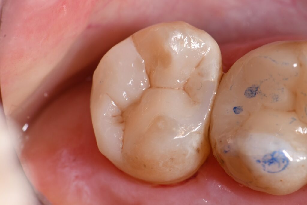 Matrix in Matrix Composite Reconstruction of Second Molar