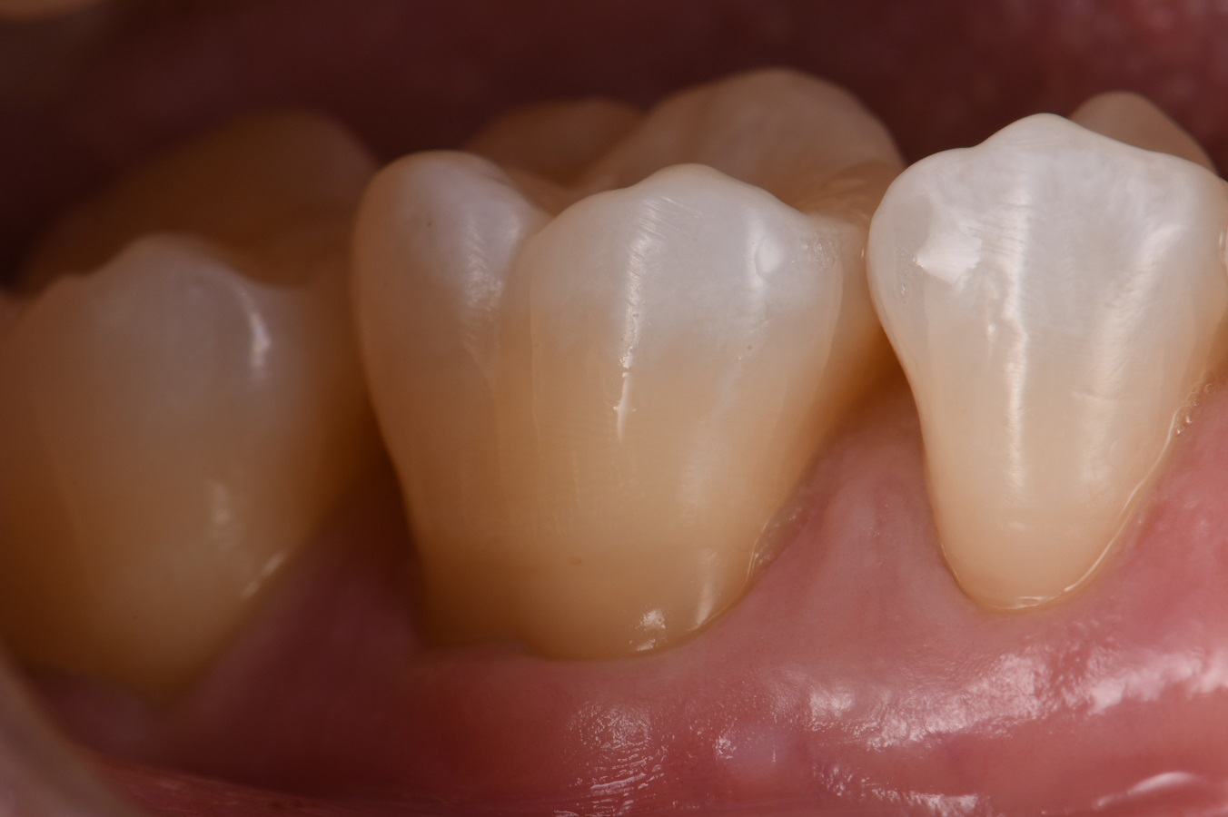 Precision Class V restoration to desensitize root
