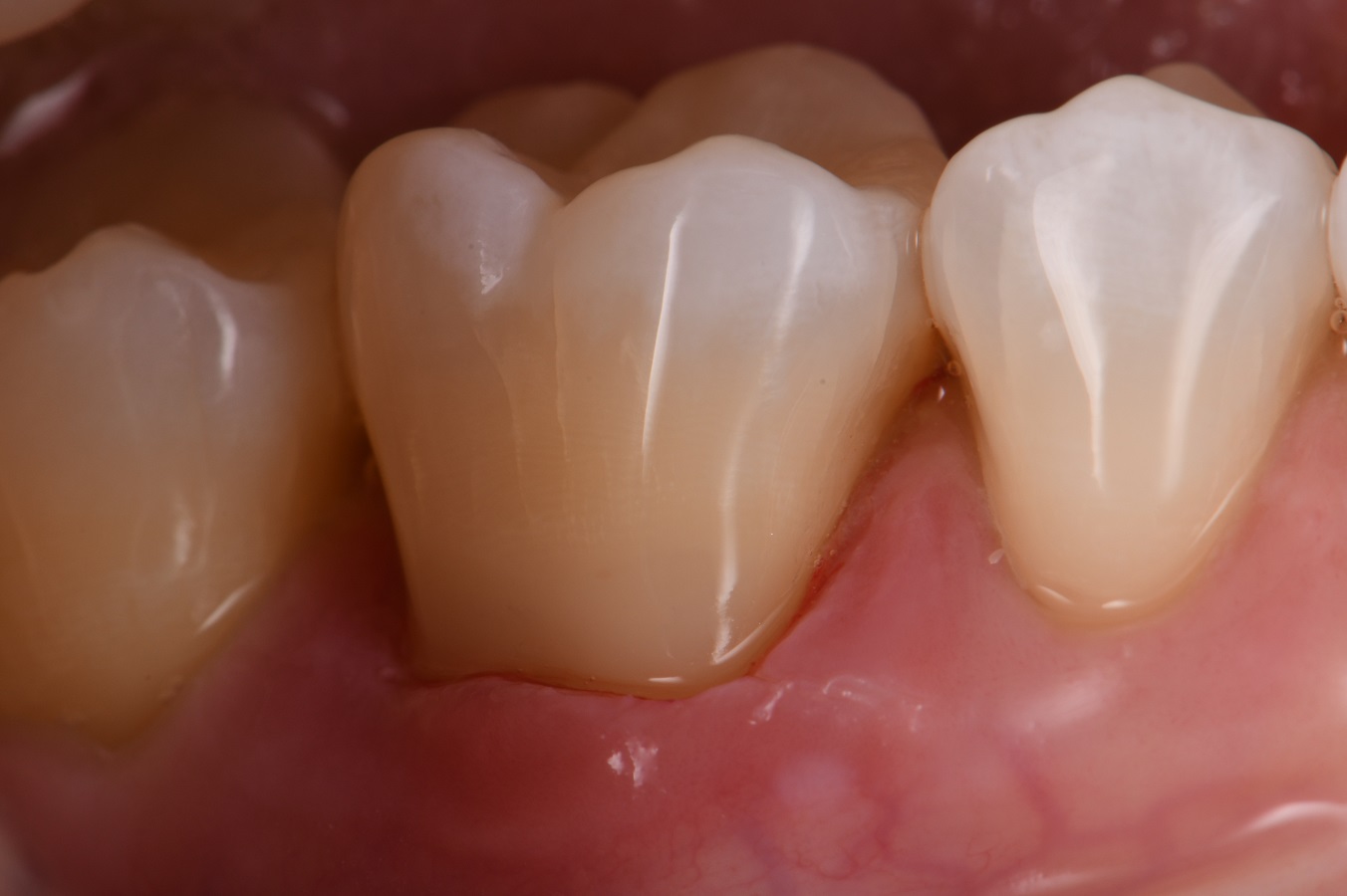 Precision Class V restoration to desensitize root