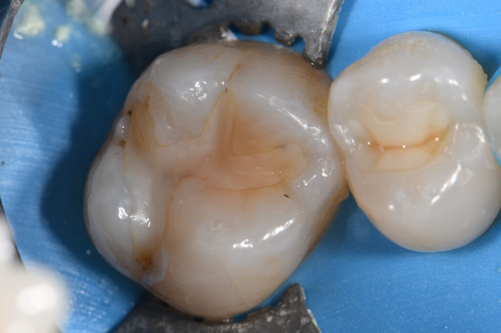 Voco Admira Fusion X-tra U bulk fill composite