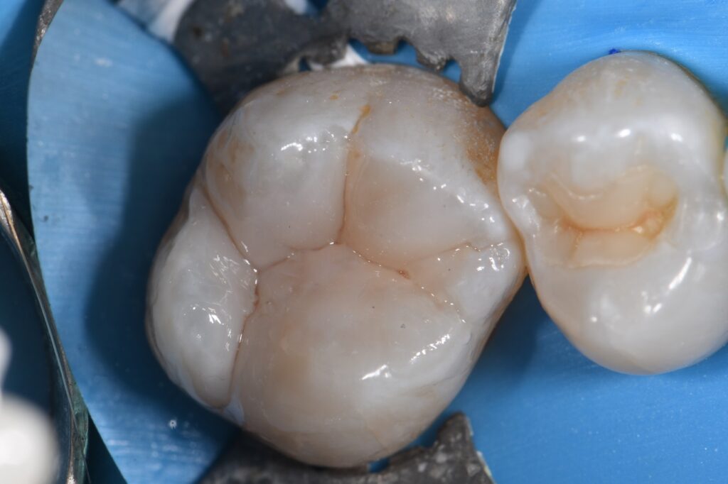 Voco Admira Fusion X-tra U bulk fill composite