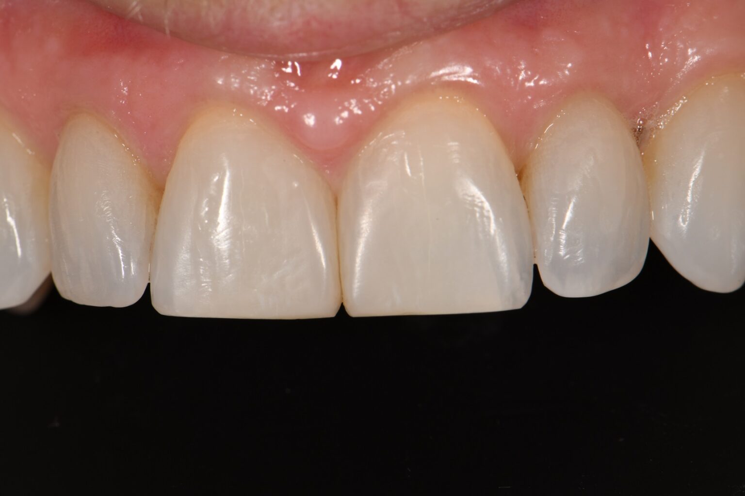 Suresmile Orthodontics | Align Bleach Bond | Voco Amaris