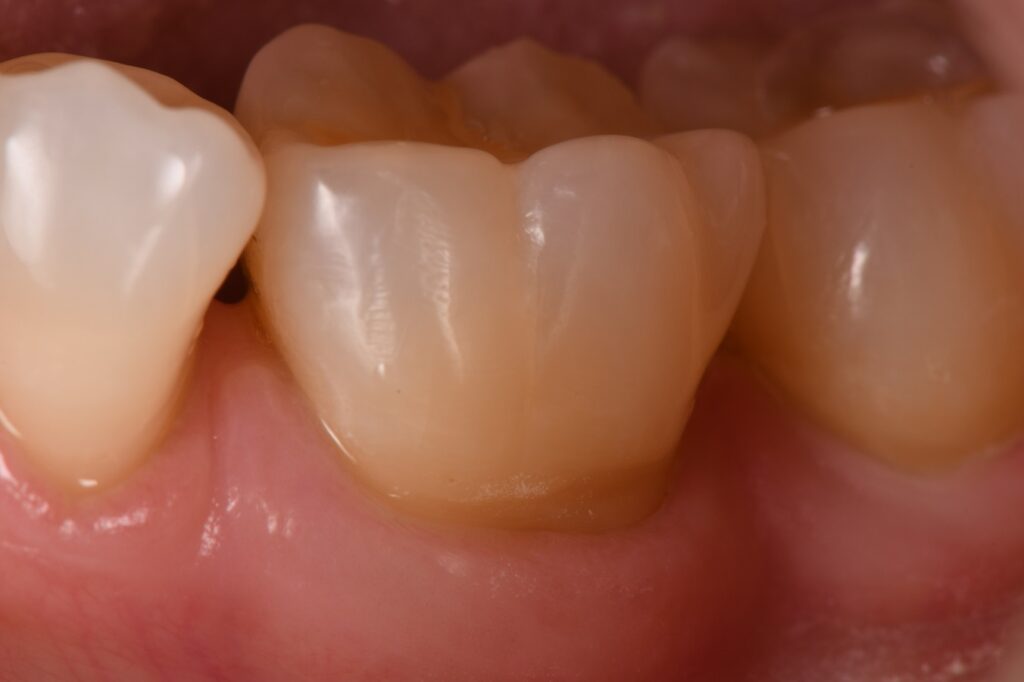 Conservative Abrasion Restorations