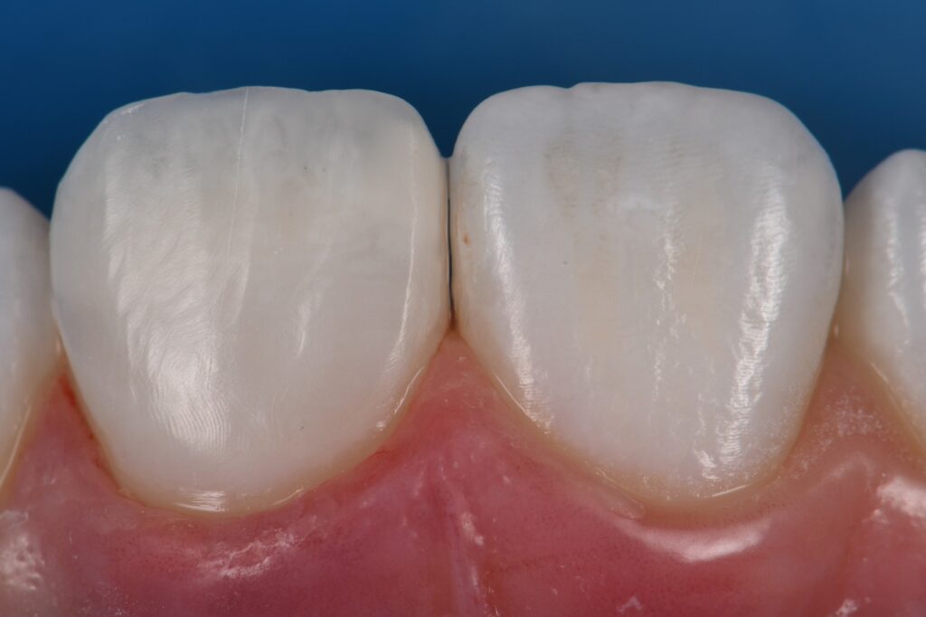 Cosmetic Treatment of Incisor Hypomineralization