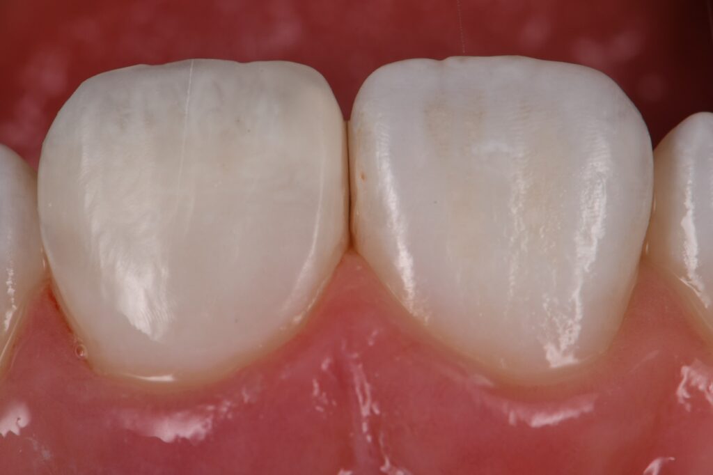 Cosmetic Treatment of Incisor Hypomineralization