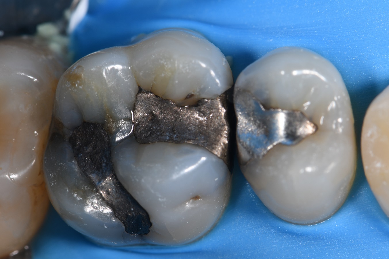 Amalgam restorations replaced with invisible composite